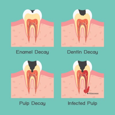 Treating Tooth Decay - Dentist Denver & Lone Tree